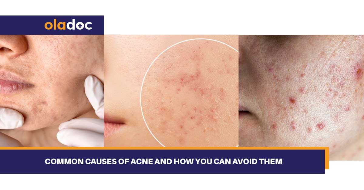 Common Causes Of Acne And How You Can Avoid Them